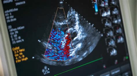 What Does Heart Ultrasound Show A Comprehensive Overview Of Cardiac