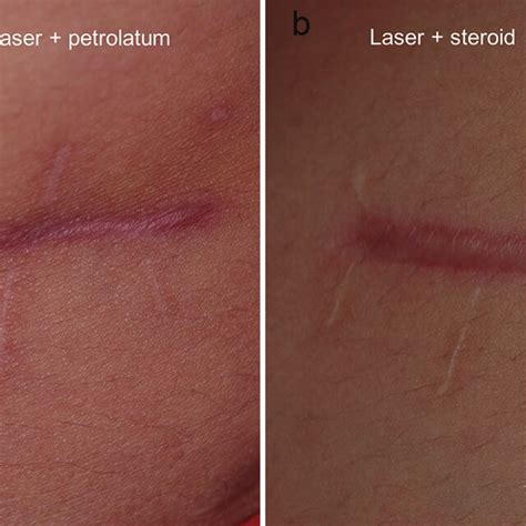 A 1­year­old Hypertrophic Appendectomy Scar Of A 30­year­old Patient