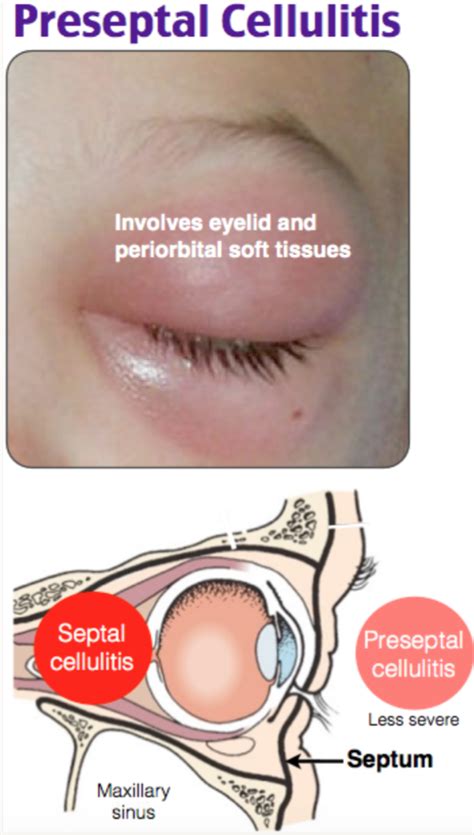 Periorbital Cellulitis Vs Orbital Cellulitis Infectious Disease