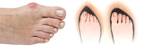 Foot Problems Are You Wearing Tight Fitting Shoes Mbt Shoes Online