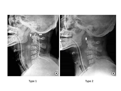 Cervical Spine Fractures And Injuries Classification Pptx Death