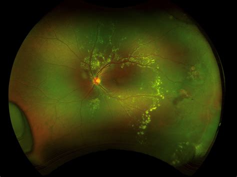 Coats Disease Widefield Fundus Image Retina Image Bank