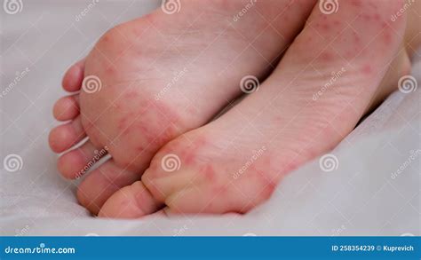 Eruzione Cutanea Dolorosa Con Macchie Rosse Vescicole Sulla Gamba