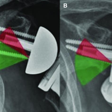 Scapular Notching Case 1 A Preoperative Ap Radiograph Showing