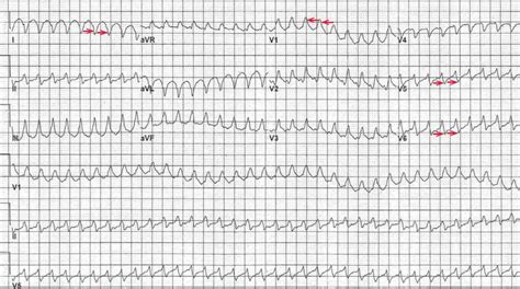 Ventricular Flutter Ecg