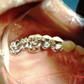 Fixed Movable Bridge In Place With Non Visible Semi Rigid Connector Download Scientific Diagram
