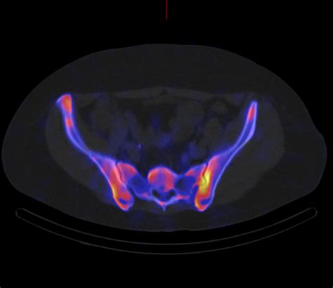 Computed Tomography Algebraic Reconstruction And Motion