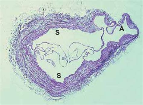 Cross Section Of A Proximal Valve Sclerosis Of The Media Ectasis And