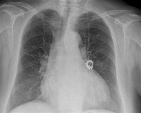 Ambulanz Für Pulmonale Hypertonie