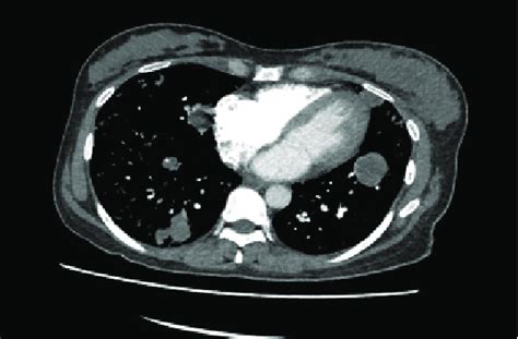 Ct Scan Findings Day 7 Download Scientific Diagram
