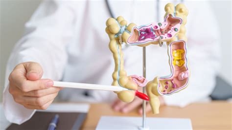 Cáncer Colorrectal Afecta Cada Vez Más A Mexicanos Menores De 30 Años