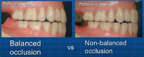 Occlusion 5 Removable Fixed And Implants Flashcards Quizlet