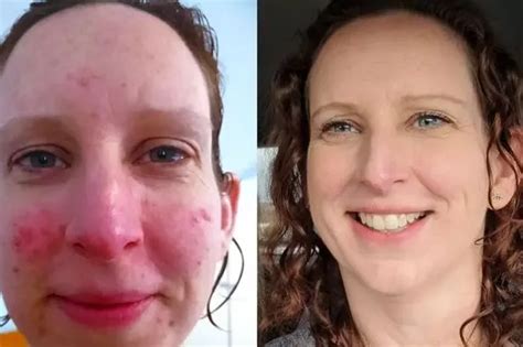 Mum Left With Red Bumps And Rash On Her Face For Months After Cooking