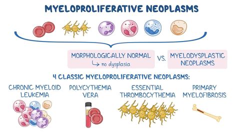 Approach To Myeloproliferative Neoplasms Clinical Sciences Osmosis