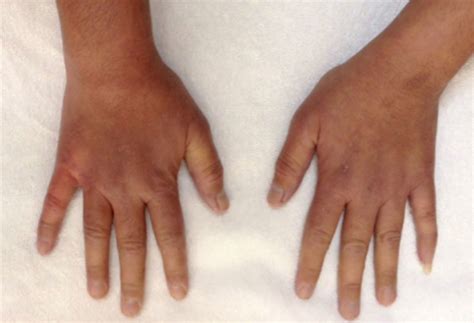 Carbimazole Induced Anca Positive Vasculitis British Journal Of