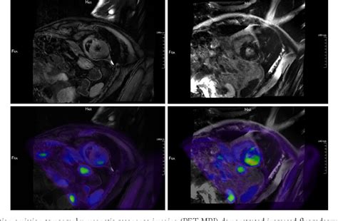 Figure 1 From Myocarditis Related To Immune Checkpoint Inhibitors