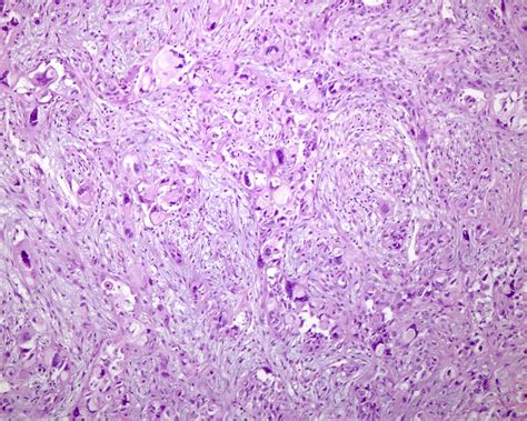 Osteosarcoma Light Micrograph Stock Image C060 1449 Science Photo Library