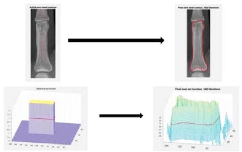 Figure 6 From Automated Bone Segmentation Using A Hybrid Model Of Drlse