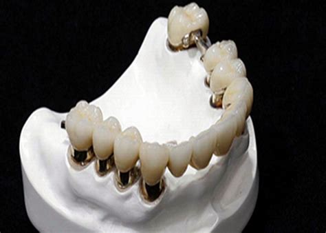Co Cr Mk1 Precision Attachment Denture Corrosion Resistance