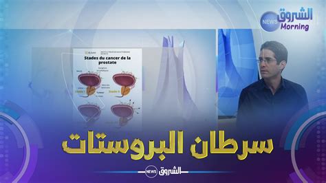 البروستات الأعراض و التشخيص لأكثر أنواع السرطان انتشارا عند الرجال