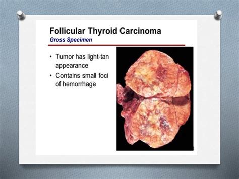 Thyroid Malignancy Ppt