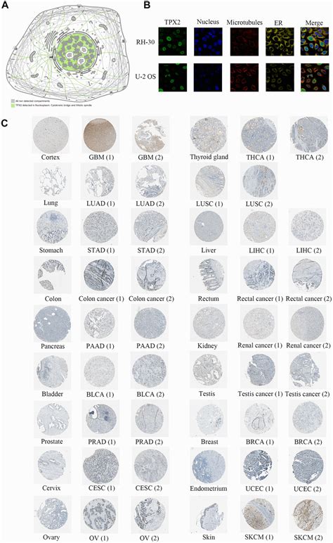 Integrative Analysis Confirms Tpx2 As A Novel Biomarker For Clinical