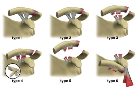 Georgios Kakavas Auf Linkedin Acromioclavicular Joint Injuries And