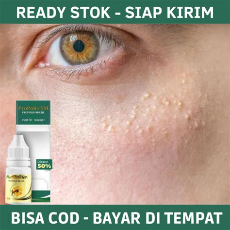 Jual Obat Penghilang Milia Pada Wajah Obat Milia Yang Sudah Bertahun