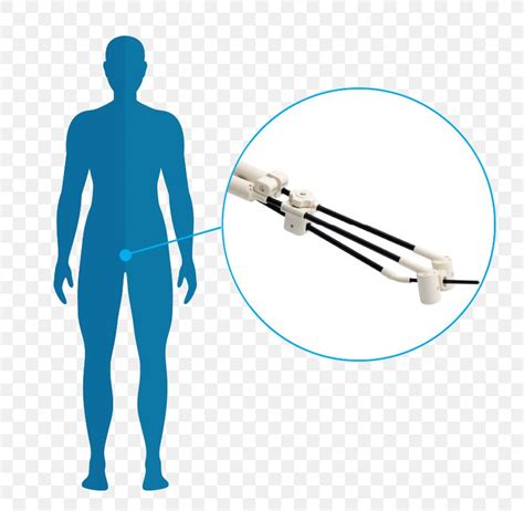 Prostate Brachytherapy Gynaecology Radiation Therapy Skin Cancer Png