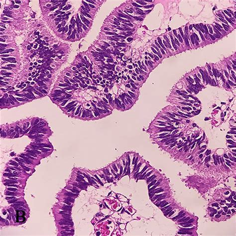 Papillary Choroid Plexus Neoplasm Showing Fibrovascular Cores A Lined