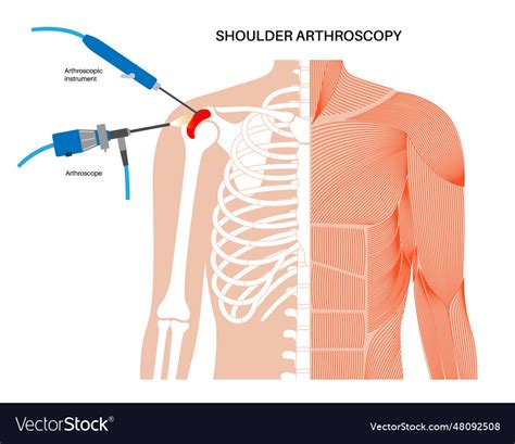 Shoulder Arthroscopy Poster Royalty Free Vector Image