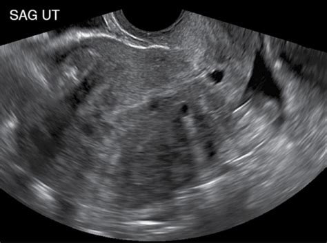 Ob Ch 43 Path Of Uterus Pt 2 Flashcards Quizlet