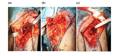 A A Bone Trough Was Created At The Femoral Neck And Head After