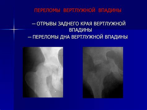 Повреждения таза и позвоночника Online Presentation