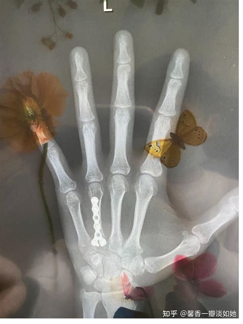 左手第四掌骨骨折记录 知乎