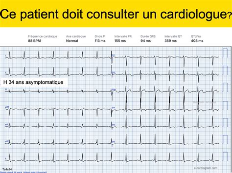 Strain Pattern E Cardiogram