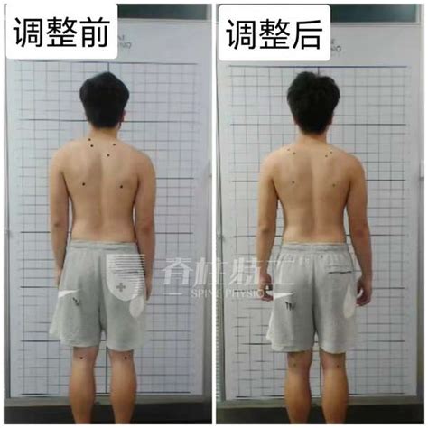 脊柱特工 的想法 进来看高低肩的矫正效果 蓝 知乎