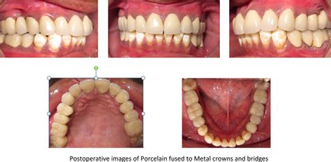 Clinical Management Of Severe Fluorosis In An Adult Bmj Case Reports