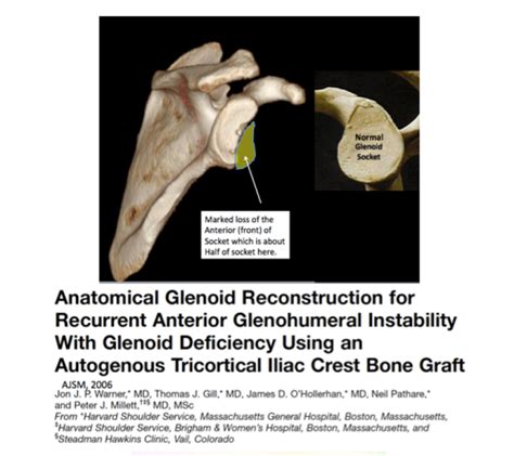 Boston Shoulder Institute Glenoid