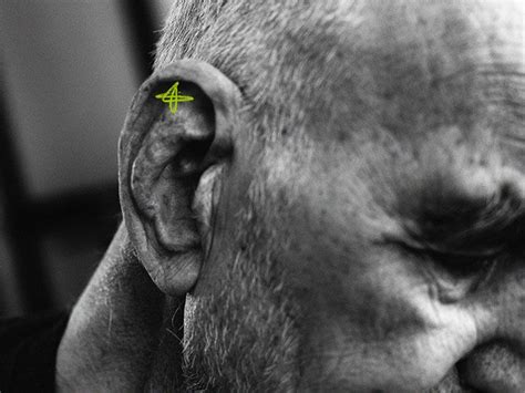Ear Melanoma Symptoms Treatment And Outlook