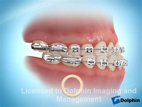 Doctors Videos Backup Dentistry Class Iii Elasticwear Hq