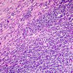 Difference Between Tag Archive For Pericarditis Pericarditis