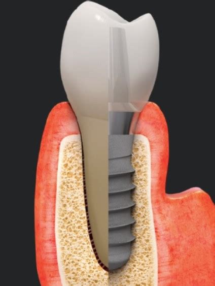 Dr John Vigneron Implants Et Chirurgie Orale à Jougne