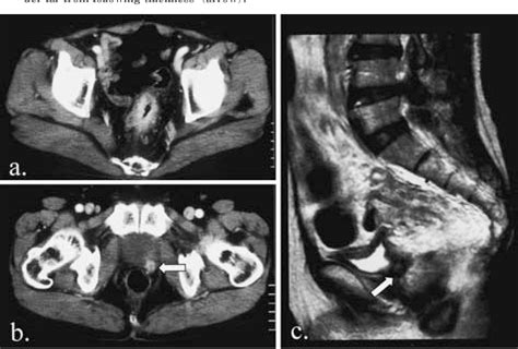 Figure 2 From A Case Of Prostatic Cancer With Rectal Metastasis And Its