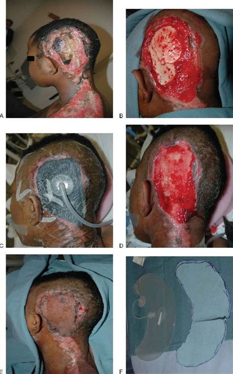 Reconstruction Of The Lateral Skin Defect Reconstruction Of The Skin And Scalp Master