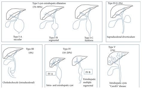 Choledochal Cyst In Adults Etiopathogenesis Presentation Management And Outcome—case Series