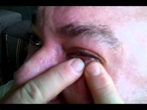 Popping A Sty YouTube