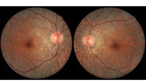 Gyrate Atrophy Extract From Cfeh Atlas Centre For Eye Health