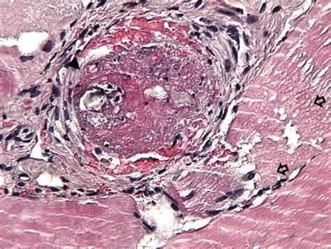 Acute Ischemic Lesions Of Muscles Including Loss Of Cross‐striations
