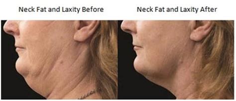 MB Neckfat